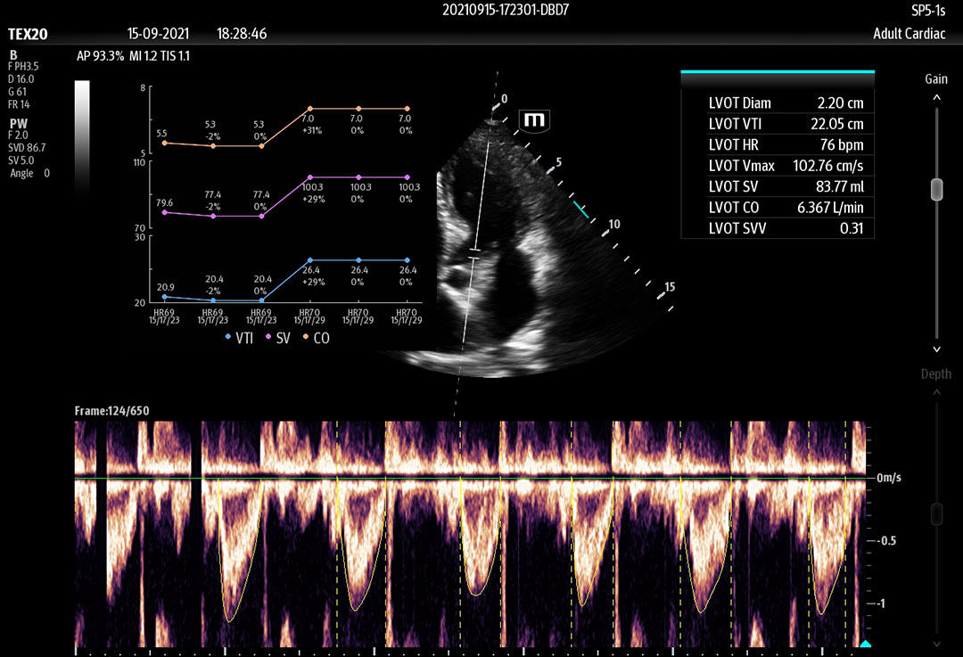 Mindray TE X Portable Ultrasound System – MavenImaging