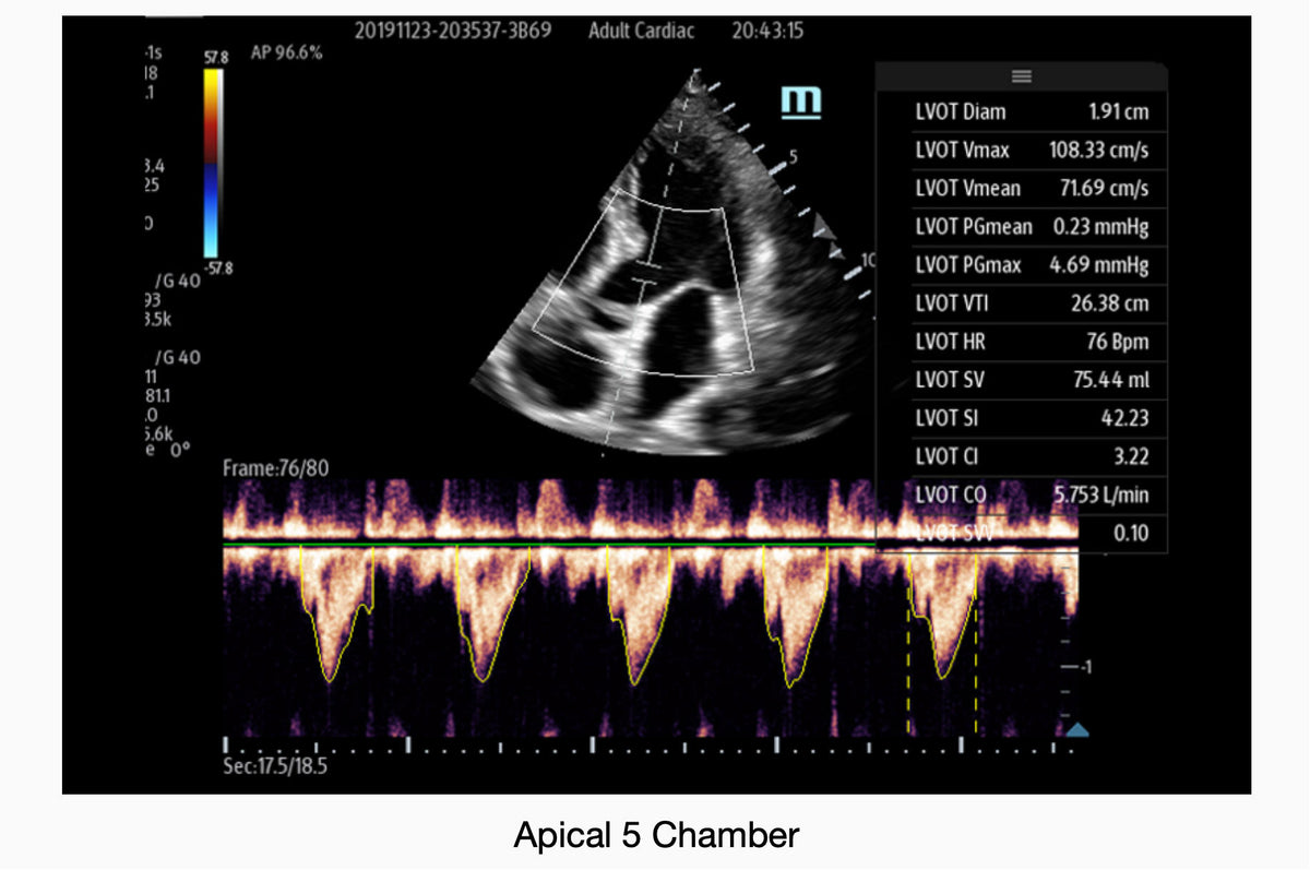 Mindray ME8 Laptop Ultrasound Machine – MavenImaging