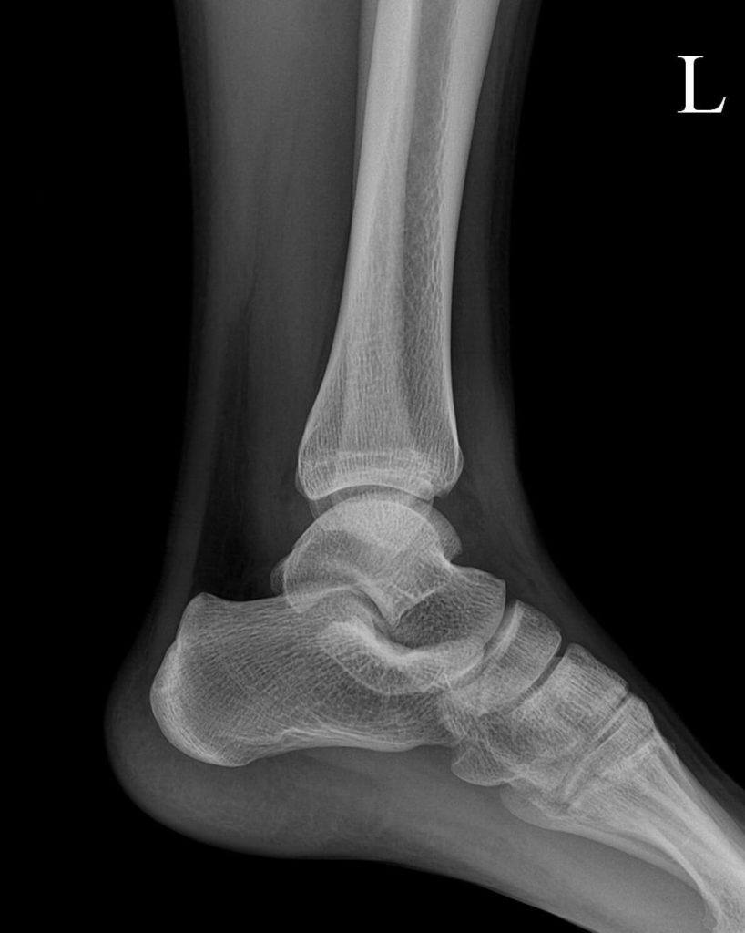 MinXray HF100H+ Portable X-ray System – MavenImaging